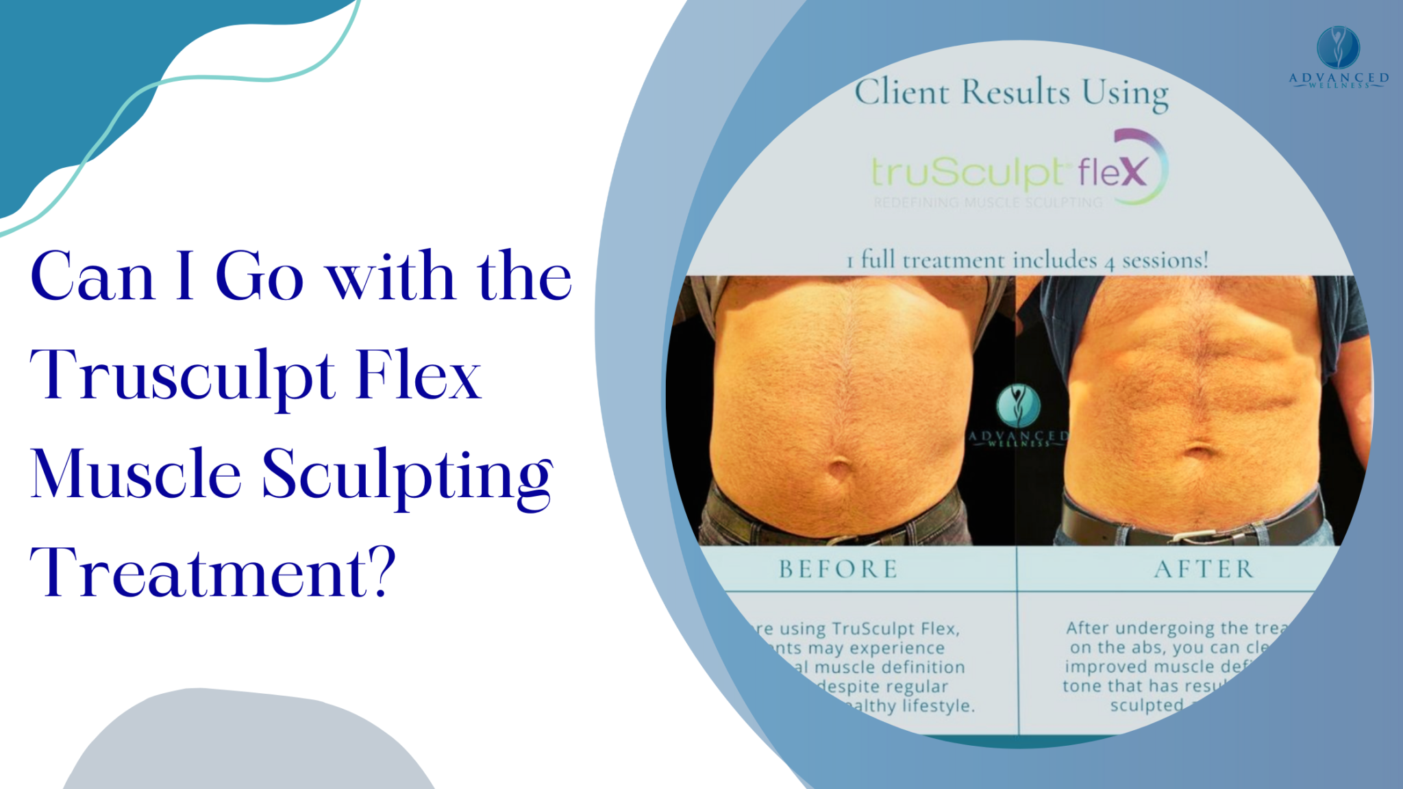 Can I Go with the Trusculpt Flex Muscle Sculpting Treatment? - Advanced ...